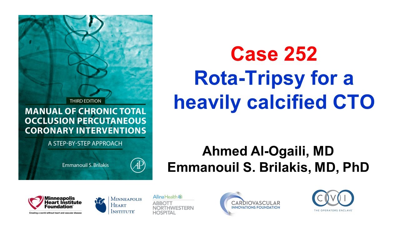 Case 252: Manual of CTO PCI - Rota-Tripsy for a heavily calcified CTO ...