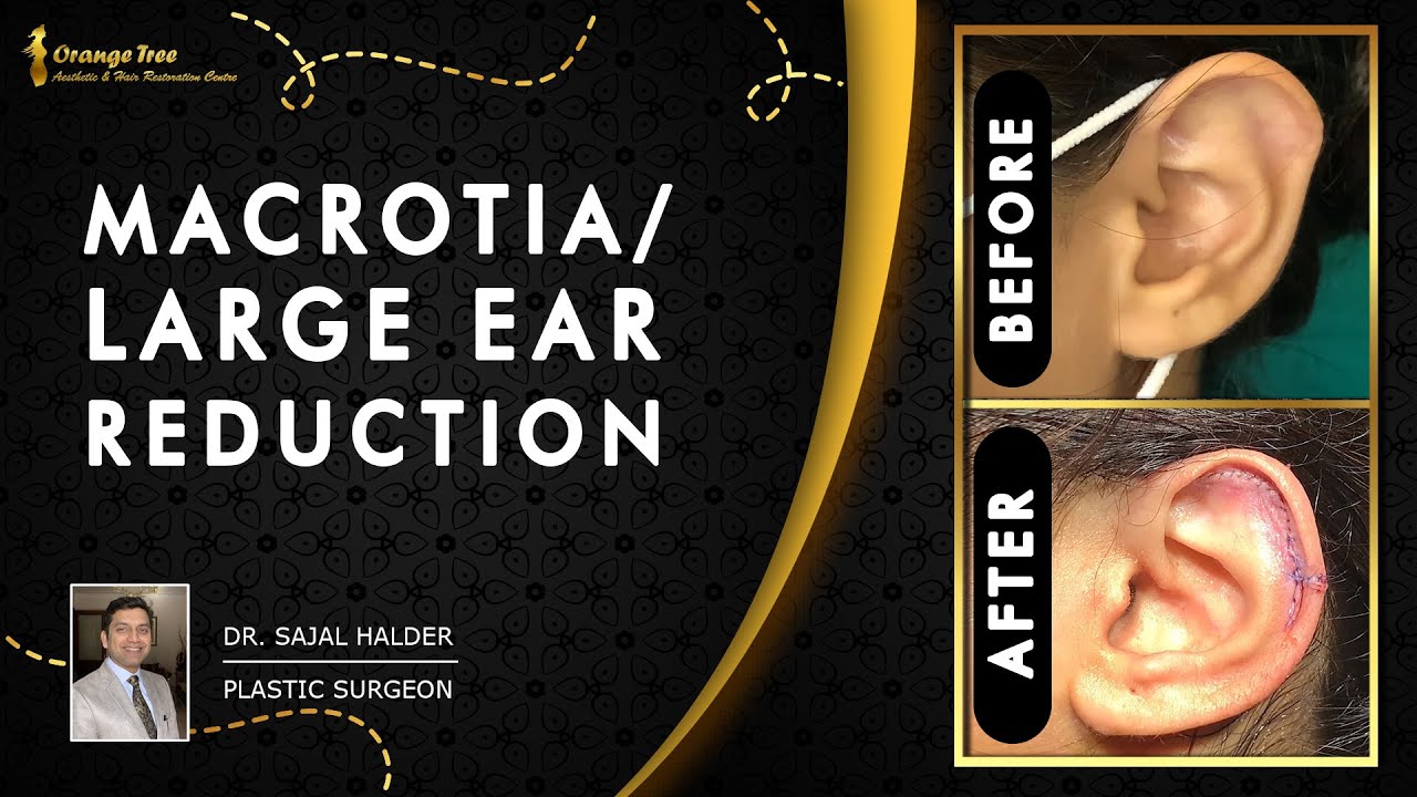 Large Ear or Macrotia Correction at Orange Tree Aeathetic Centre by Dr ...