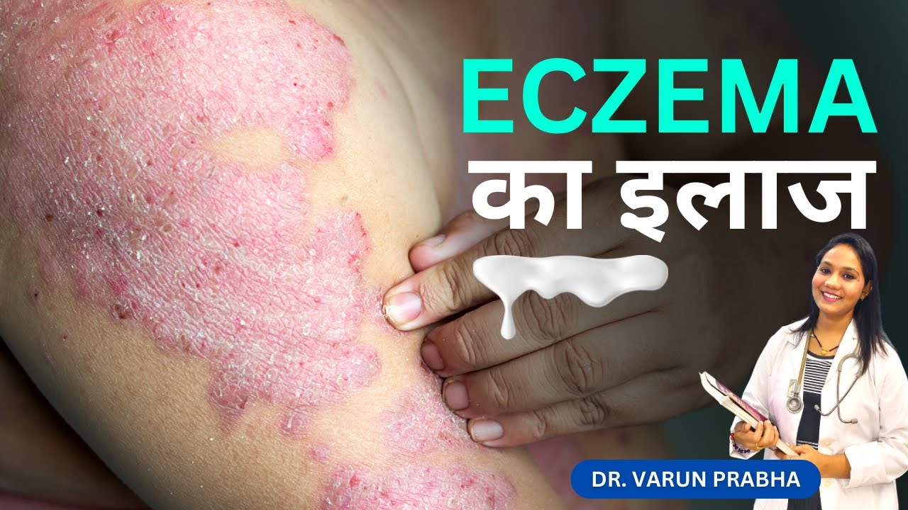 Eczema का इलाज | How to Get Rid of Eczema Permanently? - YouTube