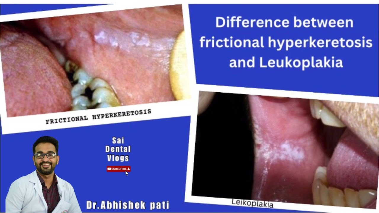 DIFFERENCE BETWEEN FRICTIONAL HYPERKERATOSIS AND LEUKOPLAKIA - YouTube
