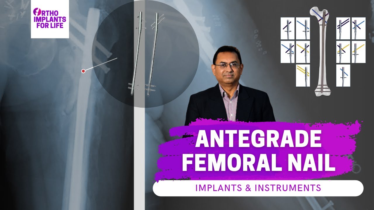 Antegrade Femoral Nail | AFN | Instruments and Uses - YouTube