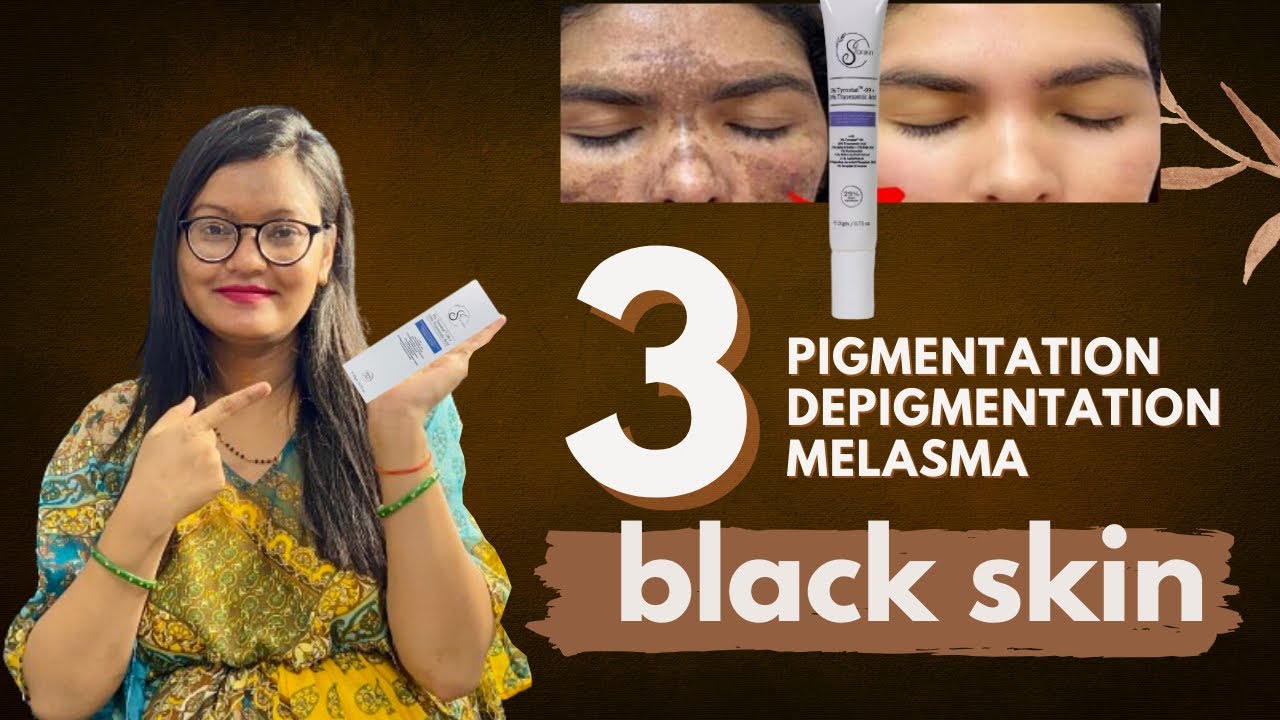 S for Skin Depigmentation cream | इतने सारे claim 😱 - YouTube