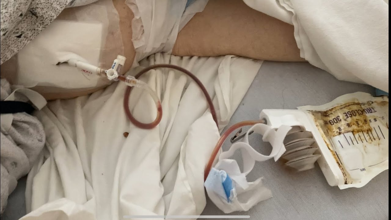 Daily Care of a Percutaneous Cholecystostomy (For gallstones ...
