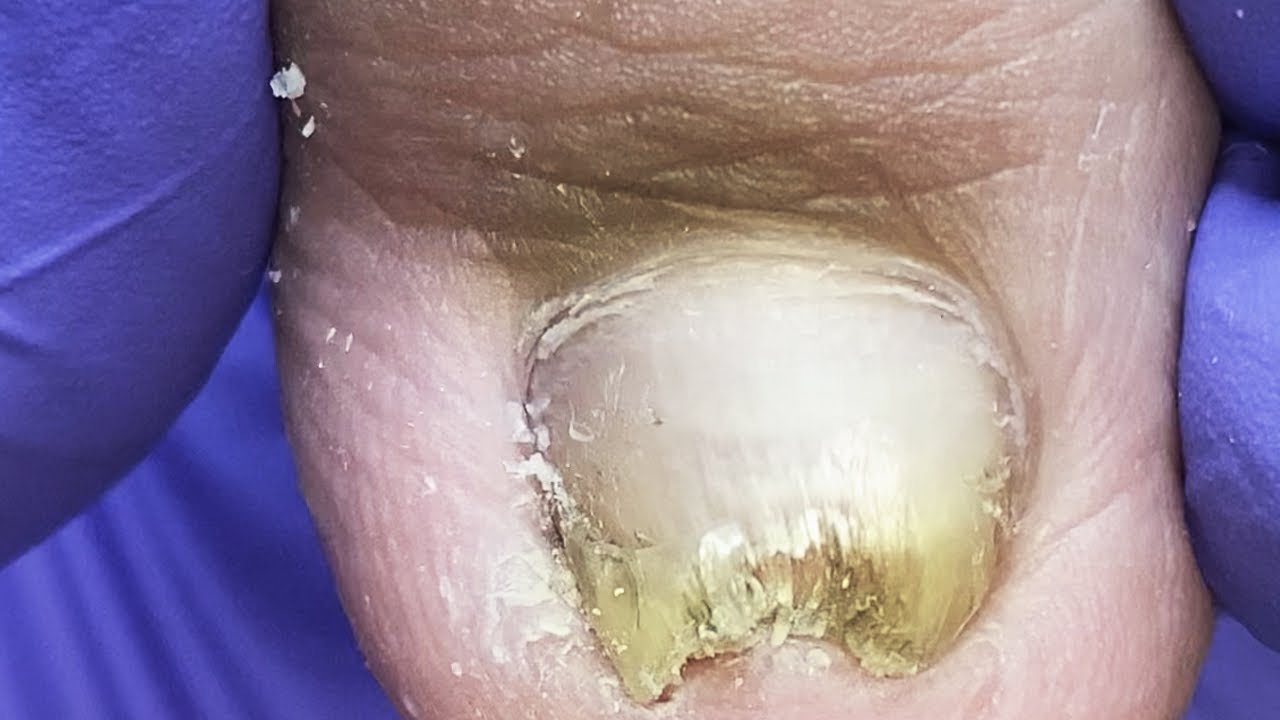 Paronychia is serious, professional pedicure quickly resolves【Doctor ...