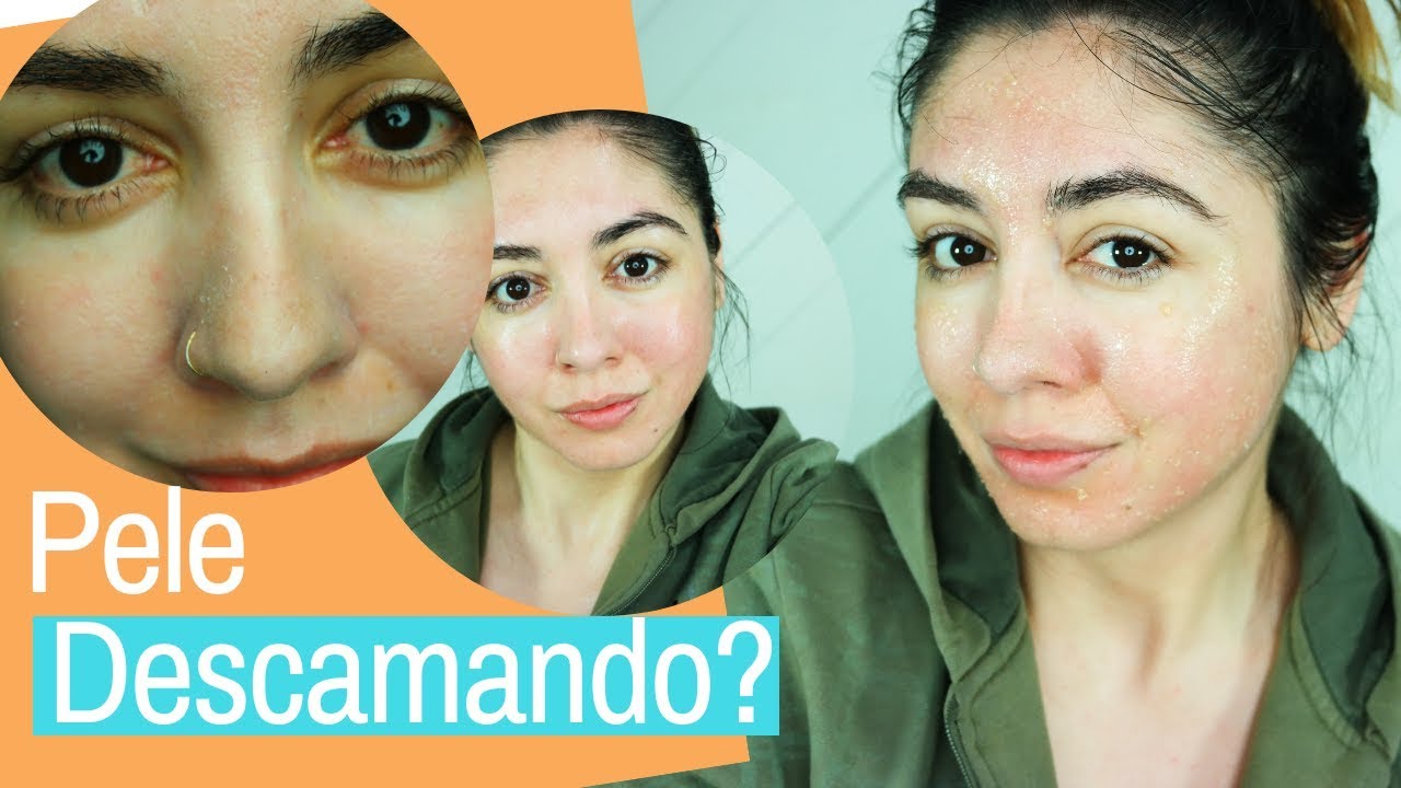 Pele descamando por causa do Vitanol | Esfoliação + Máscara caseira p ...