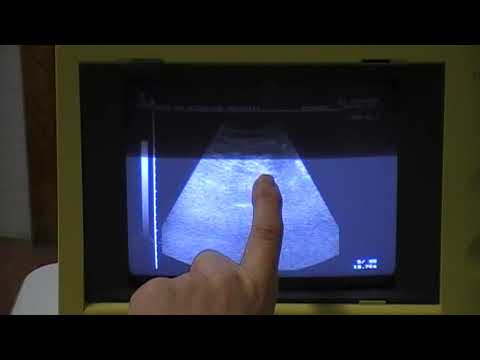 Extended FAST (eFAST) - YouTube