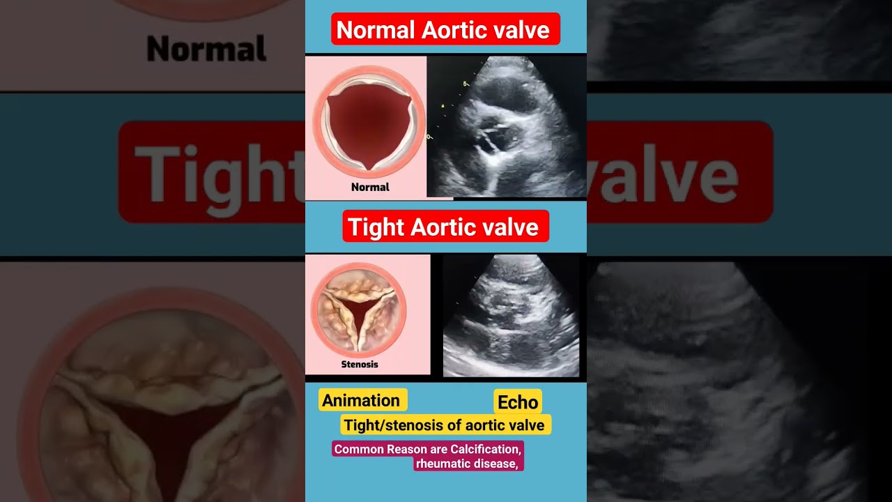 Normal Aortic Valve
