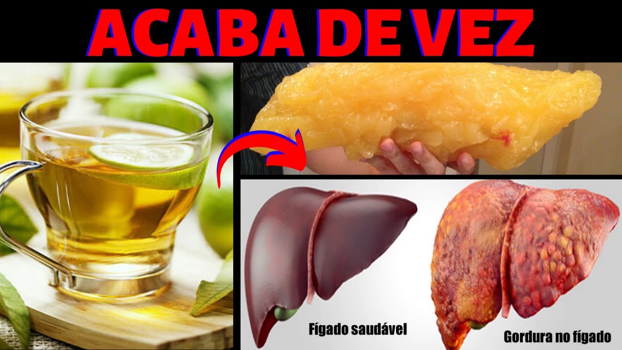 Remédio Caseiro Para Fígado Gordo - RETOEDU
