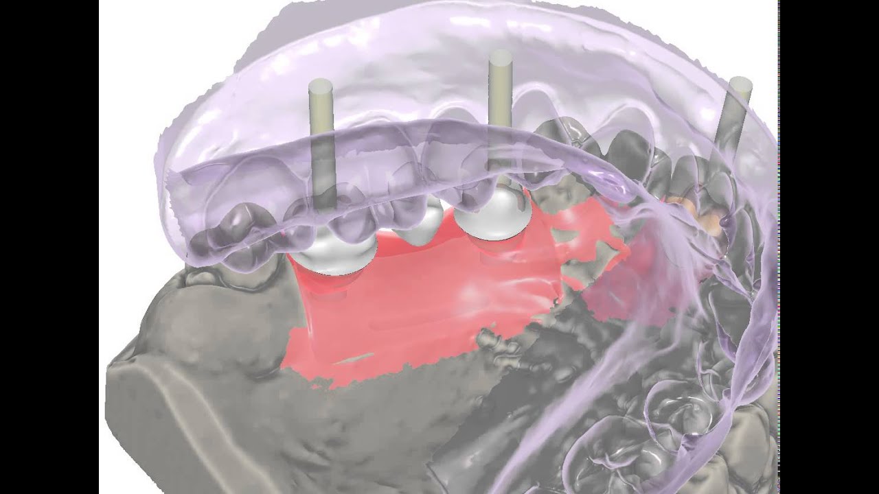 exocad modulo impianti2 - YouTube