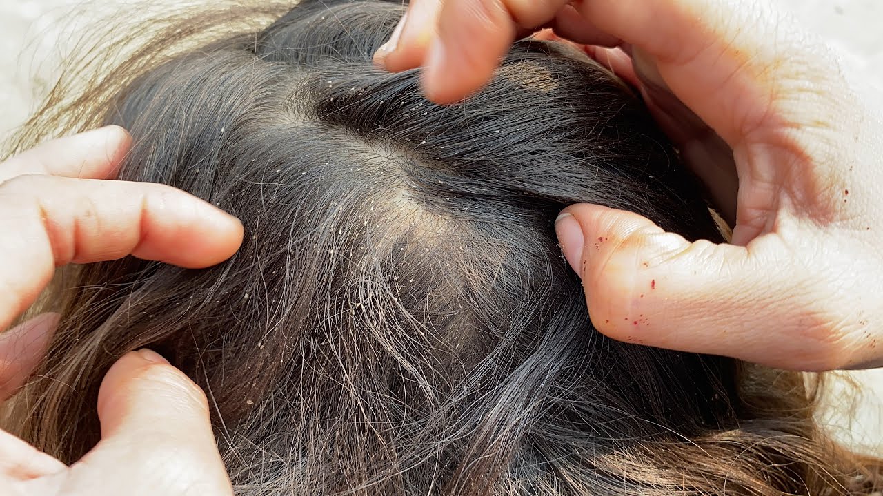 #ASMR checking lice and nits. and hunting lots ofnits 💯 asmr lice check ...