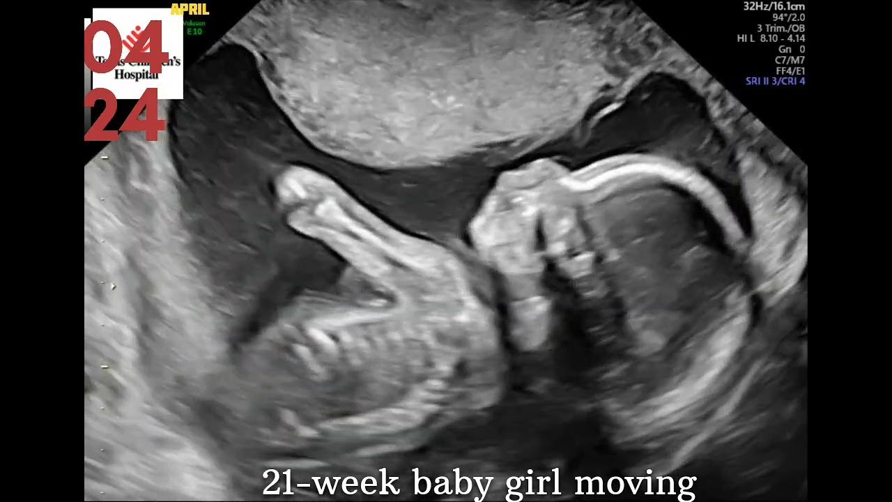 fetus scan -21 weeks baby girl - YouTube