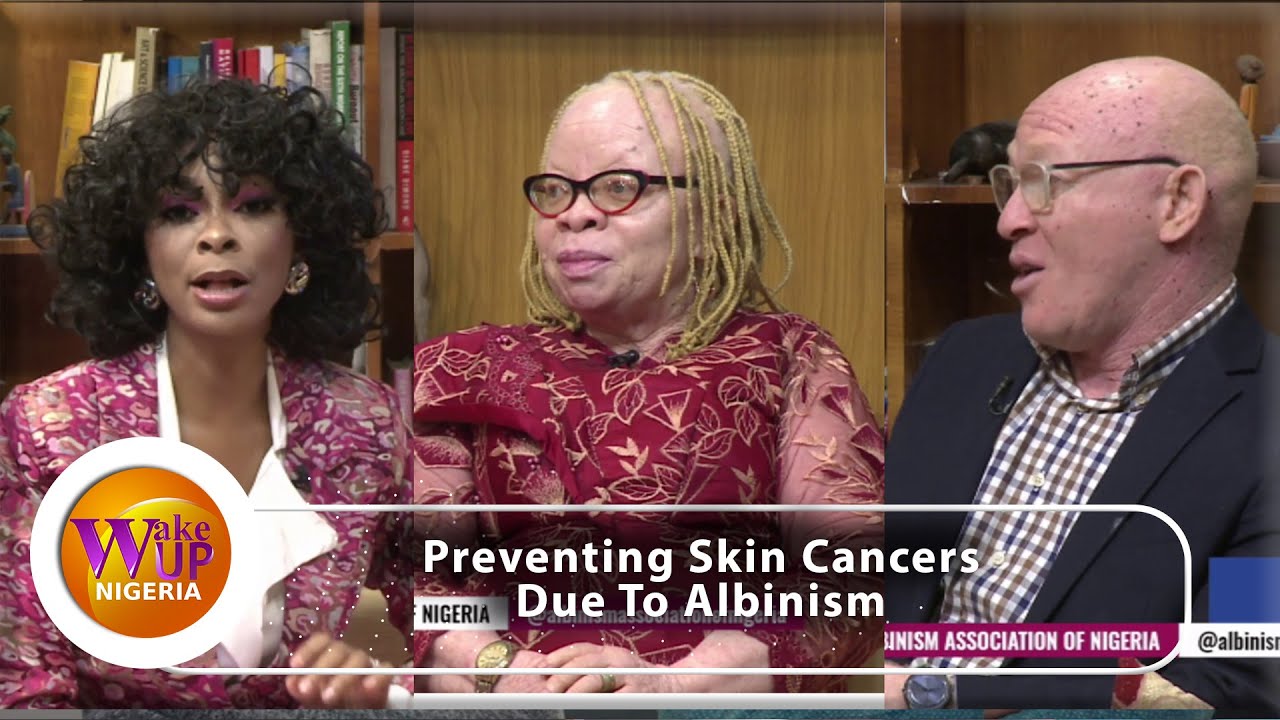 Prevention And Early Management Of Skin Cancer For Albinos | VIDEO ...