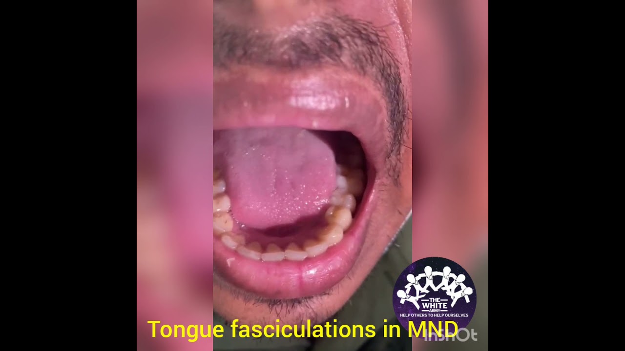 Unilateral Tongue Atrophy And Fasciculation Neuro Focal Muscular