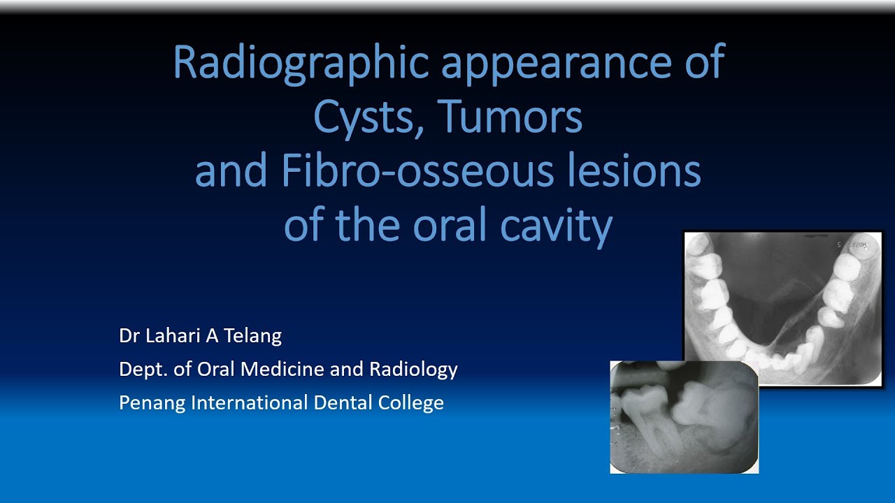 Radiographic Appearance Of Cysts Tumors And Fibro Osseous Lesions Of radiographic-appearance-of-cysts-tumors-and-fibro-osseous-lesions-of