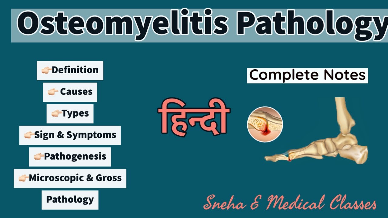 Osteomyelitis !! Causes !! Sign & Symptoms !! Pathogenesis !! Gross ...