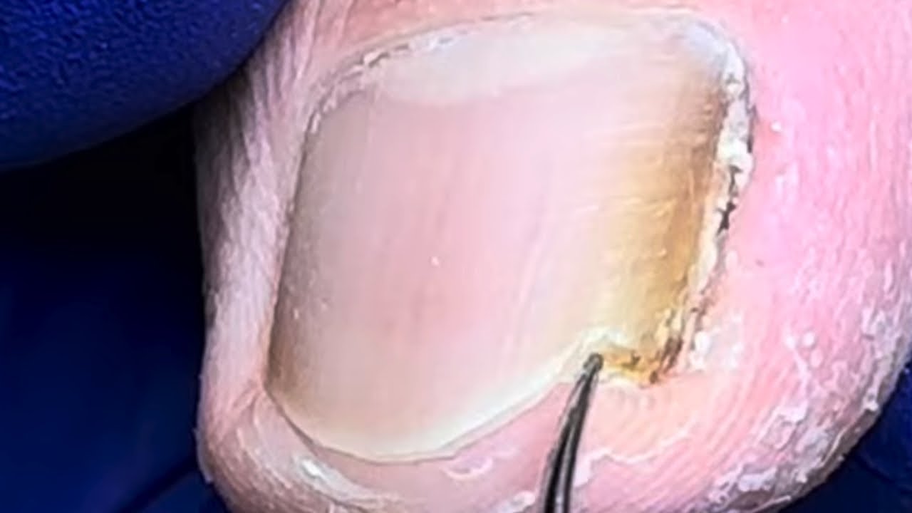 Wow~ Large pieces of layered embedded nails, pulled out layer by layer ...