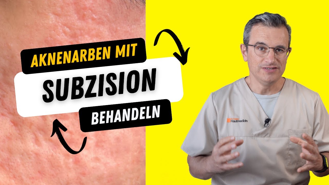 Aknenarben entfernen mit der Subzision: Dr. Kasten Hautmedizin in Mainz ...