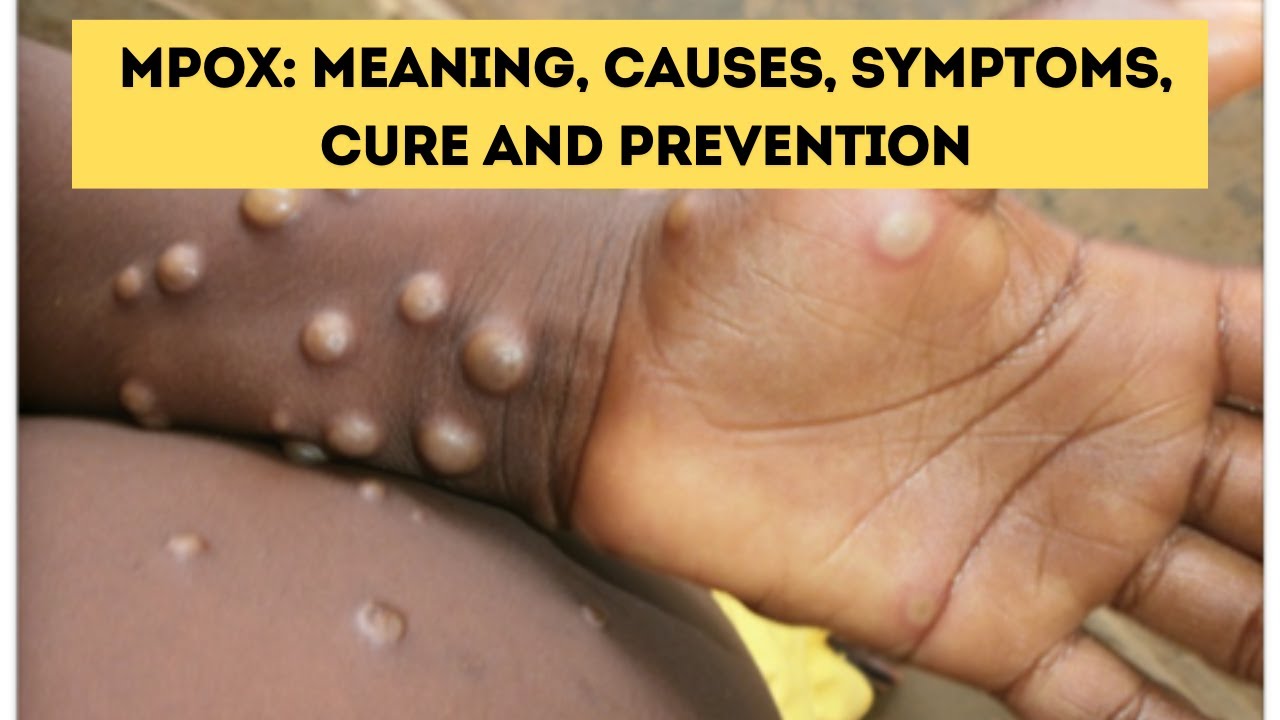 Mpox: Meaning, Causes, Symptoms, Cure and Prevention - YouTube