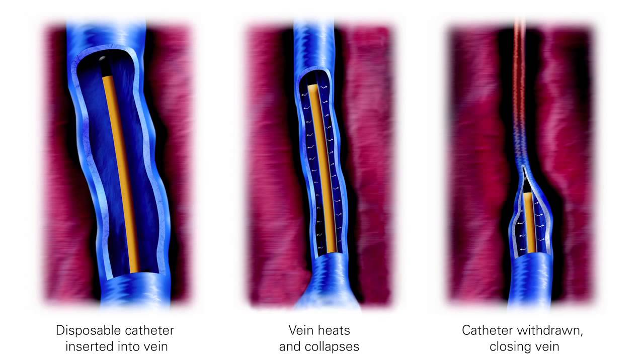 What is Venefit? | Island Vein Specialists - YouTube