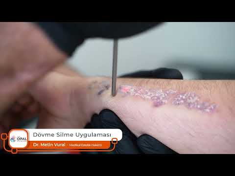 Lazerle Dövme Silme İşlemi - Ameliyatsız Dövme Silme