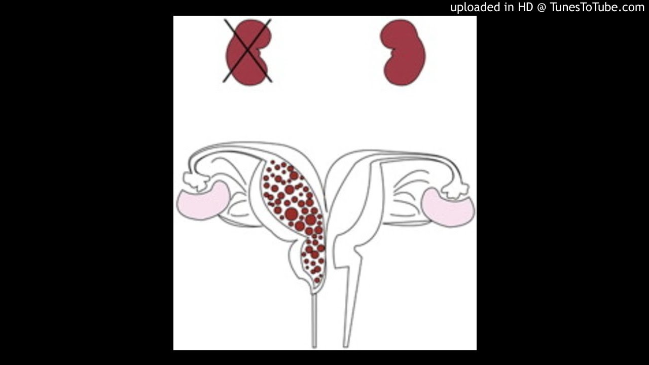 Obstructed hemivagina and ipsilateral renal anomaly (OHVIRA) syndrome ...
