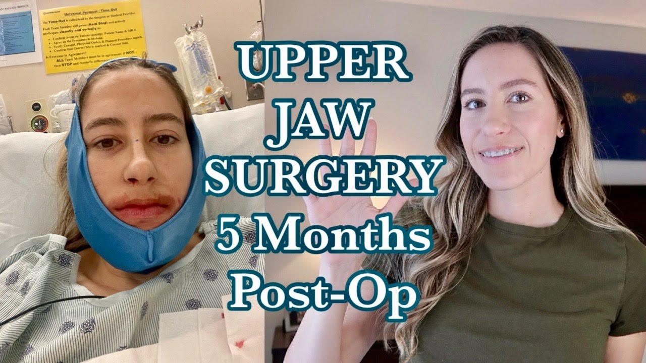 Upper Jaw Surgery | 4 Months Post-Op - YouTube
