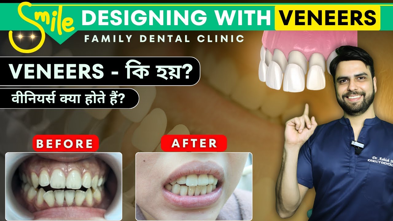 Veeners in details | How, When and Why Veneers needed ? | Dr. Ashish ...