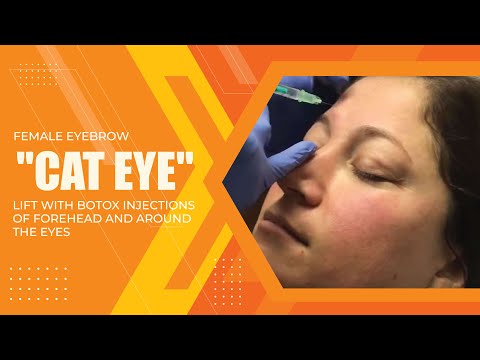 FEMALE EYEBROW "CAT EYE" LIFT WITH BOTOX INJECTIONS OF FOREHEAD AND ...