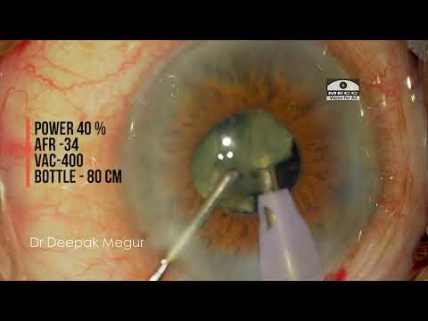 Phacoemulsification in an eye with small pupil - Understanding strategies , Dr Deepak Megur