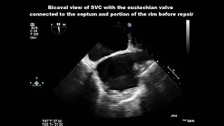 Prominent Eustachian Valve