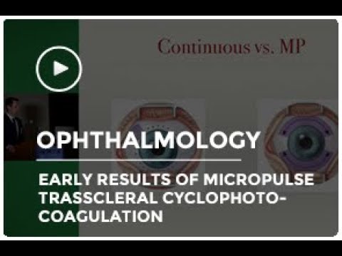Early Results of Micropulse Trasscleral Cyclophotocoagulation - YouTube