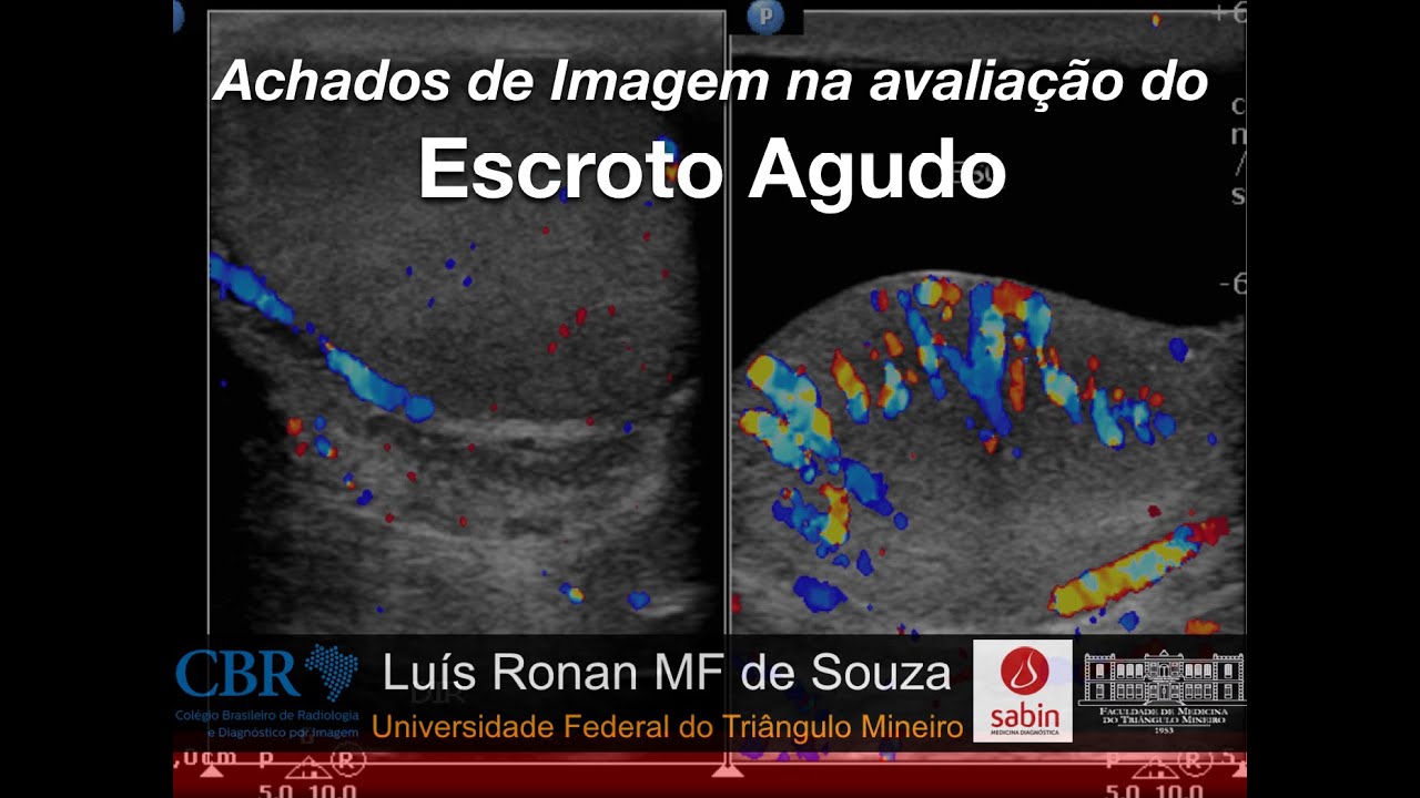 Escroto agudo: achados de ultrassonografia. - YouTube