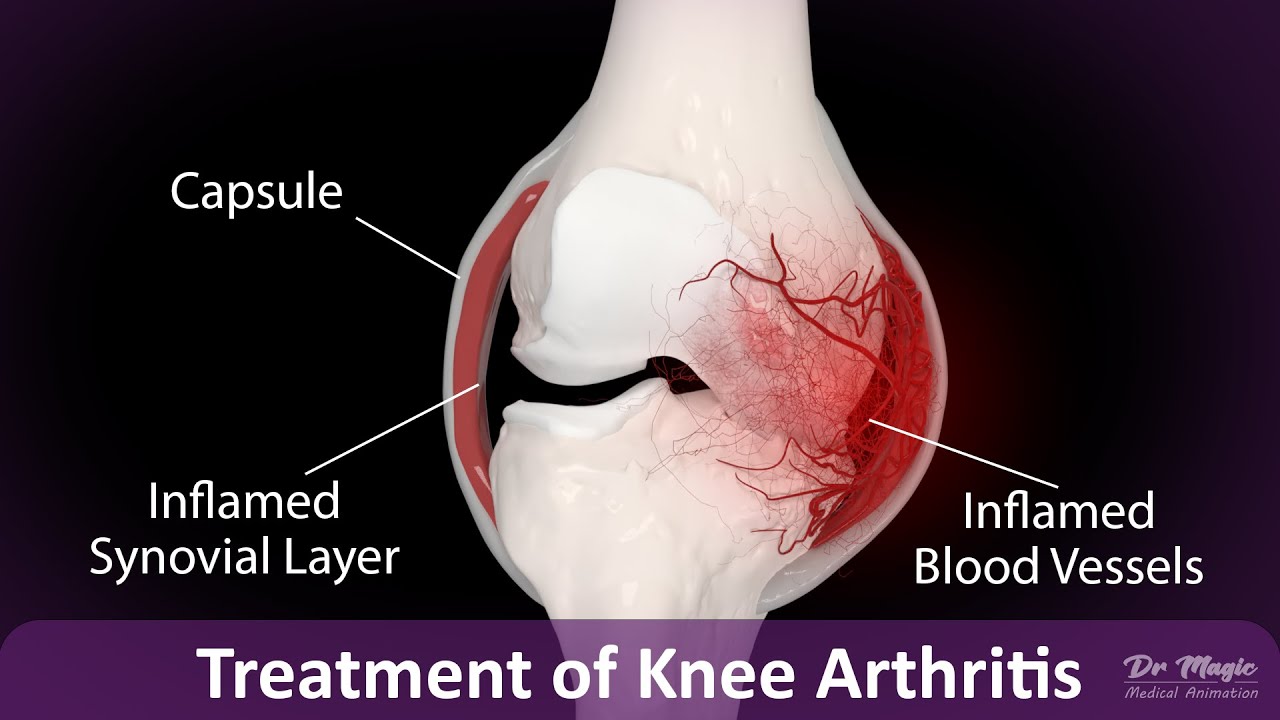 Arthritis Knee Embolization Procedure - YouTube