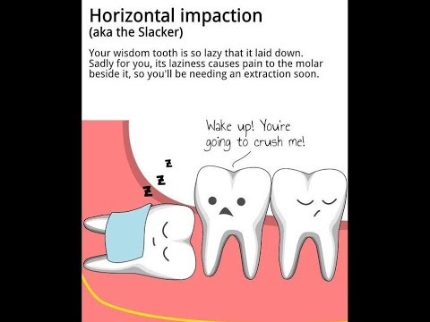 Horizontally Impacted 3rd Molar Extraction - Without Bone Removal - YouTube