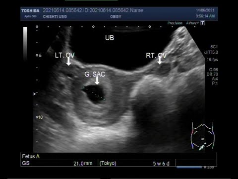 A Blighted ovum also called as Anembryonic pregnancy. - YouTube