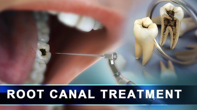 Root Canal Treatment Procedure Step By Step