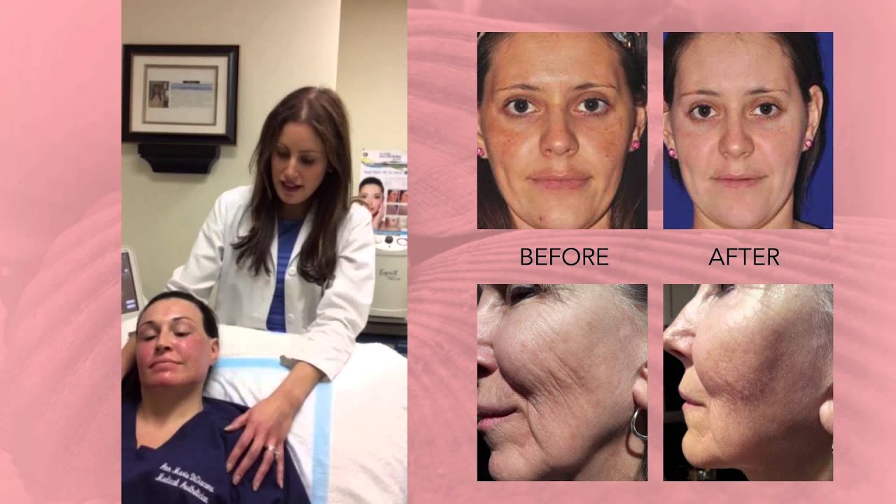 Eclipse Micropen Treatment with PRP by Dr. Micheline Giovani at ...
