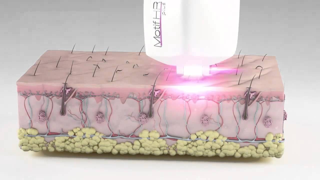 Elase Hair Removal Treatment Clip Motif Mode - YouTube