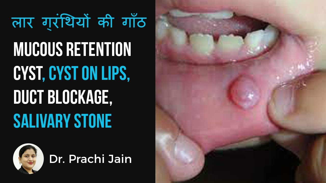 Mucous retention cyst लार ग्रंथियों की गाँठ , CYST on lips, swelling ...