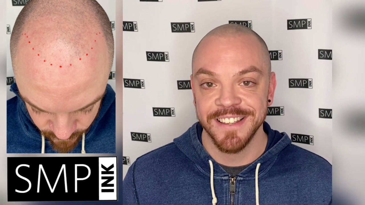 SMP Ink - Scalp Micropigmentation Before and After! - YouTube