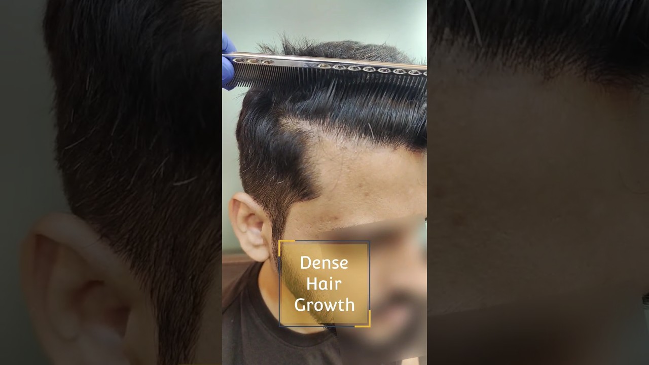Transforming Your Hairline: The Power of Hair Transplant and Har Line ...