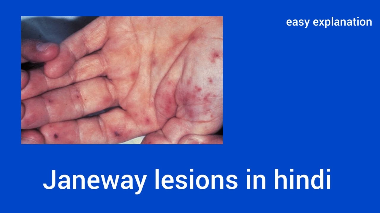 Janeway Lesions Endocarditis