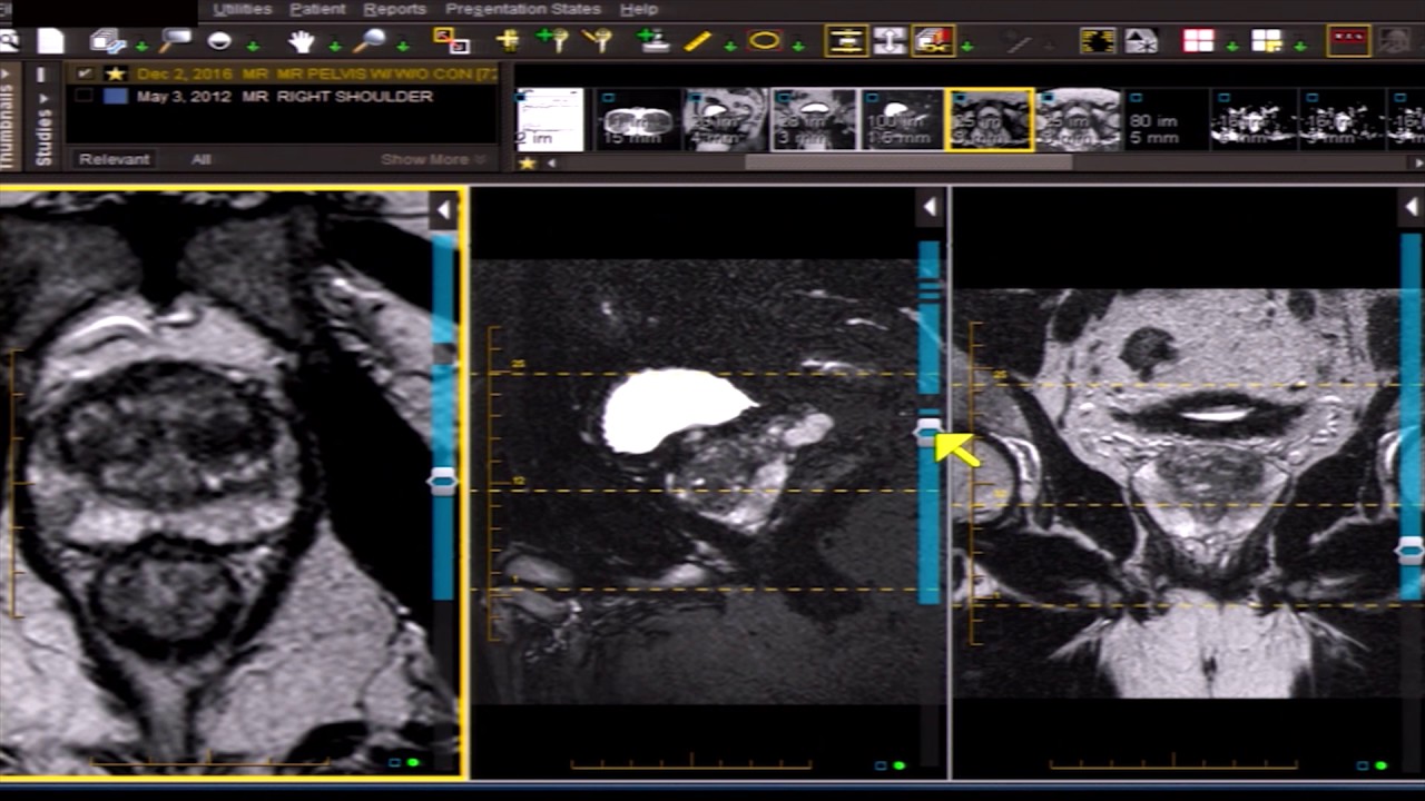 Prostate MRI Case Review: A Look at PI RADS 2.0 Terminology - YouTube