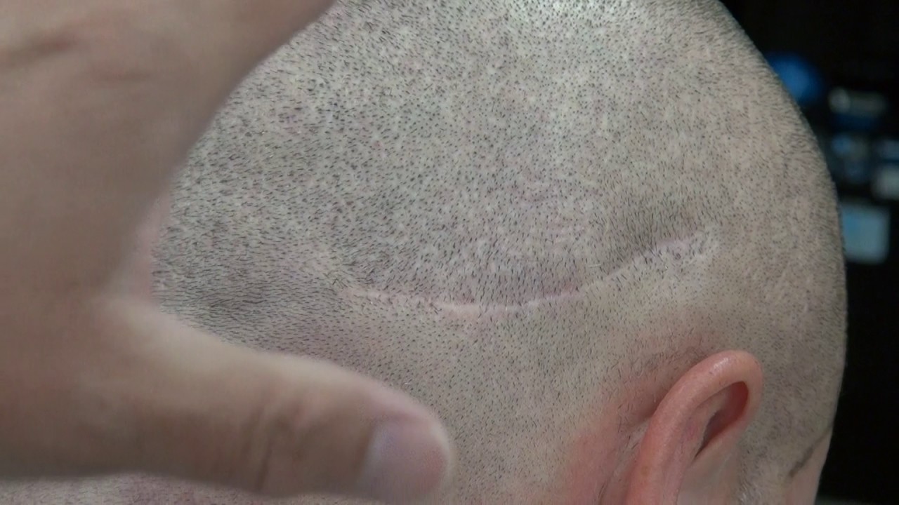 Dr. Diep FUT vs. FUE Scar Hair Transplant Donor Scar http://www ...