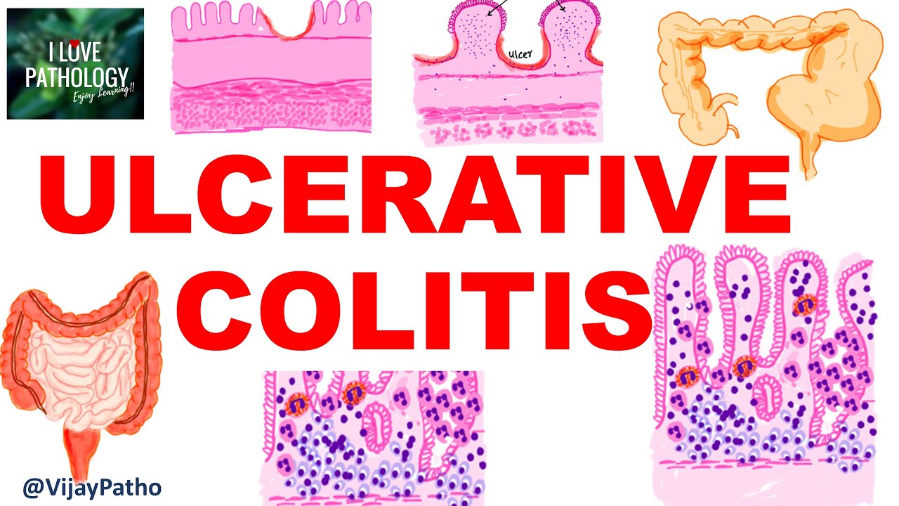 Ulcerative Colitis Explained | Pathogenesis, Morphology & Pathology ...