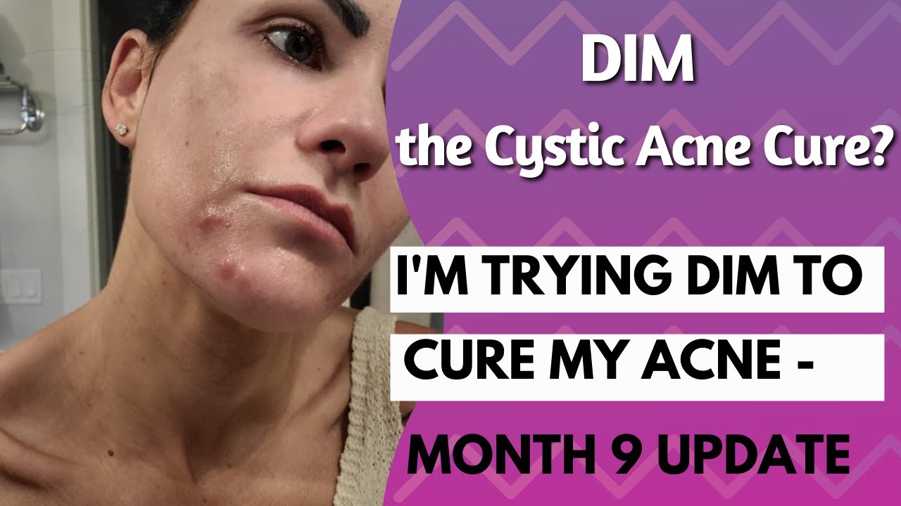 #DIM The Cystic Acne Cure???? Part 9 Update! - Month 9 - YouTube