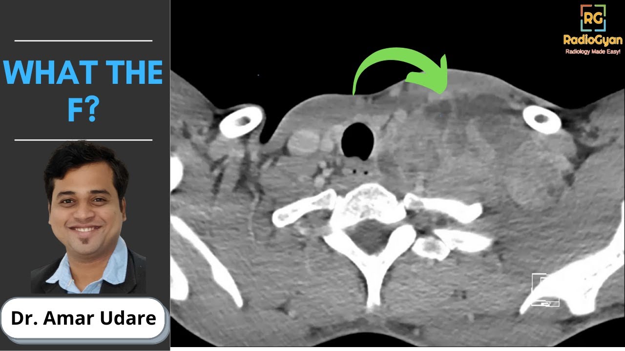 Virchow's nodes, Troisier sign and Cancer | Radiology Capsule - YouTube