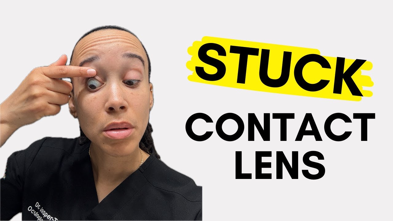 How to Remove a Stuck Contact Lens (Without a Slit Lamp) - YouTube