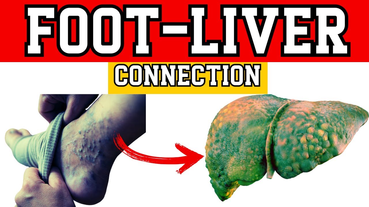 What our feet tell us about symptoms of liver disease? - YouTube