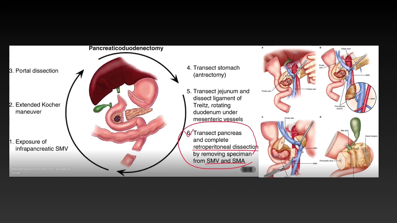 Mesopancreas Dissection of Laparoscopic Pancreaticoduodenectomy - YouTube